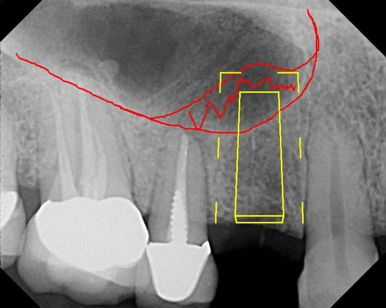 Sinus Bone Lifting - Internal