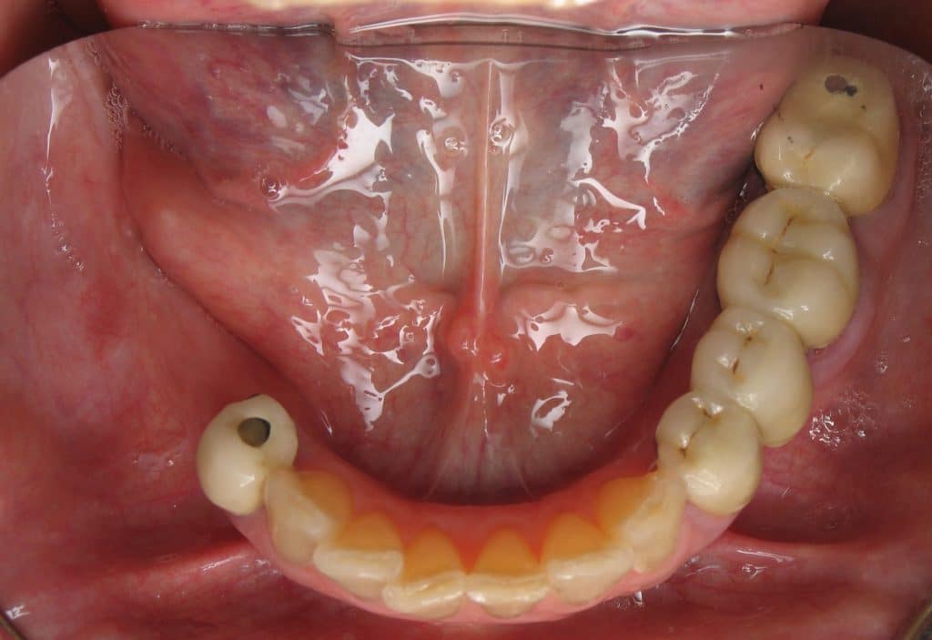 Dental Implant Case Example For Back Teeth