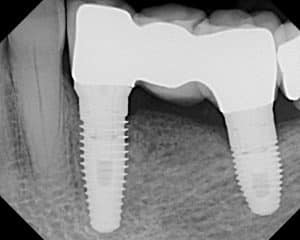 Dental Implant X-rays