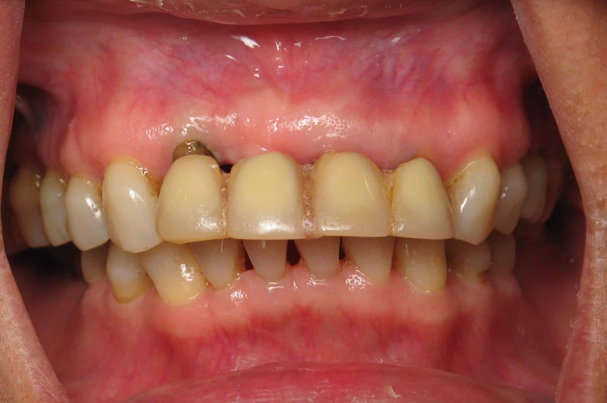 The Ovate Pontic – Ramsey Amin DDS of Burbank Explains This Dental ... The Ovate Pontic – Ramsey Amin DDS of Burbank Explains This Dental ...