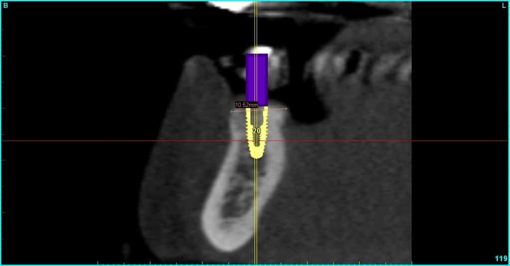 Dental CT Scans and Bone Width For Implants - Burbank Implant Expert ...