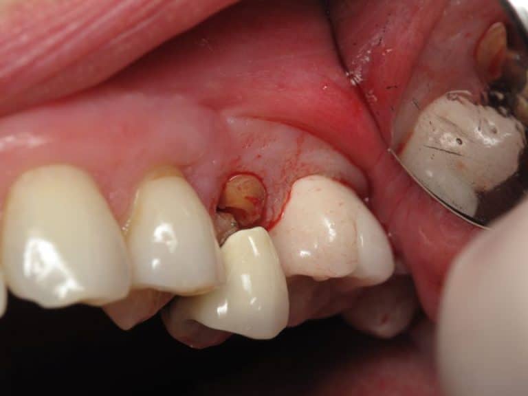 Broken Tooth - Slanted Dental Implant Crown Fixed