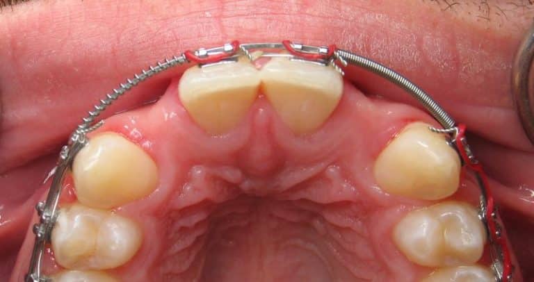 Burbank Implant Dentist Explains Titanium Mesh Bone Grafting for Dental ...