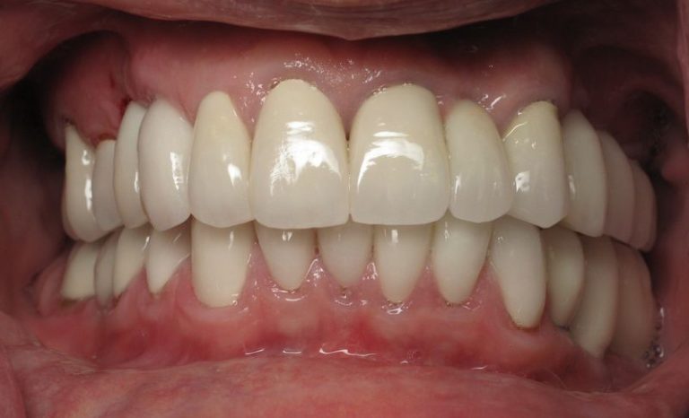 CT Scan for Dentistry Archives - Burbank Dental Implants