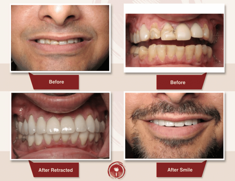 Full Mouth Restoration