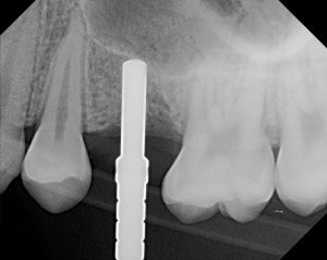 Dizzy/Vertigo After Sinus Lift Bone Graft for Dental Implant