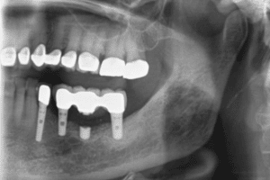 Losing Bone on My Dental Implant -Too Much Cement?