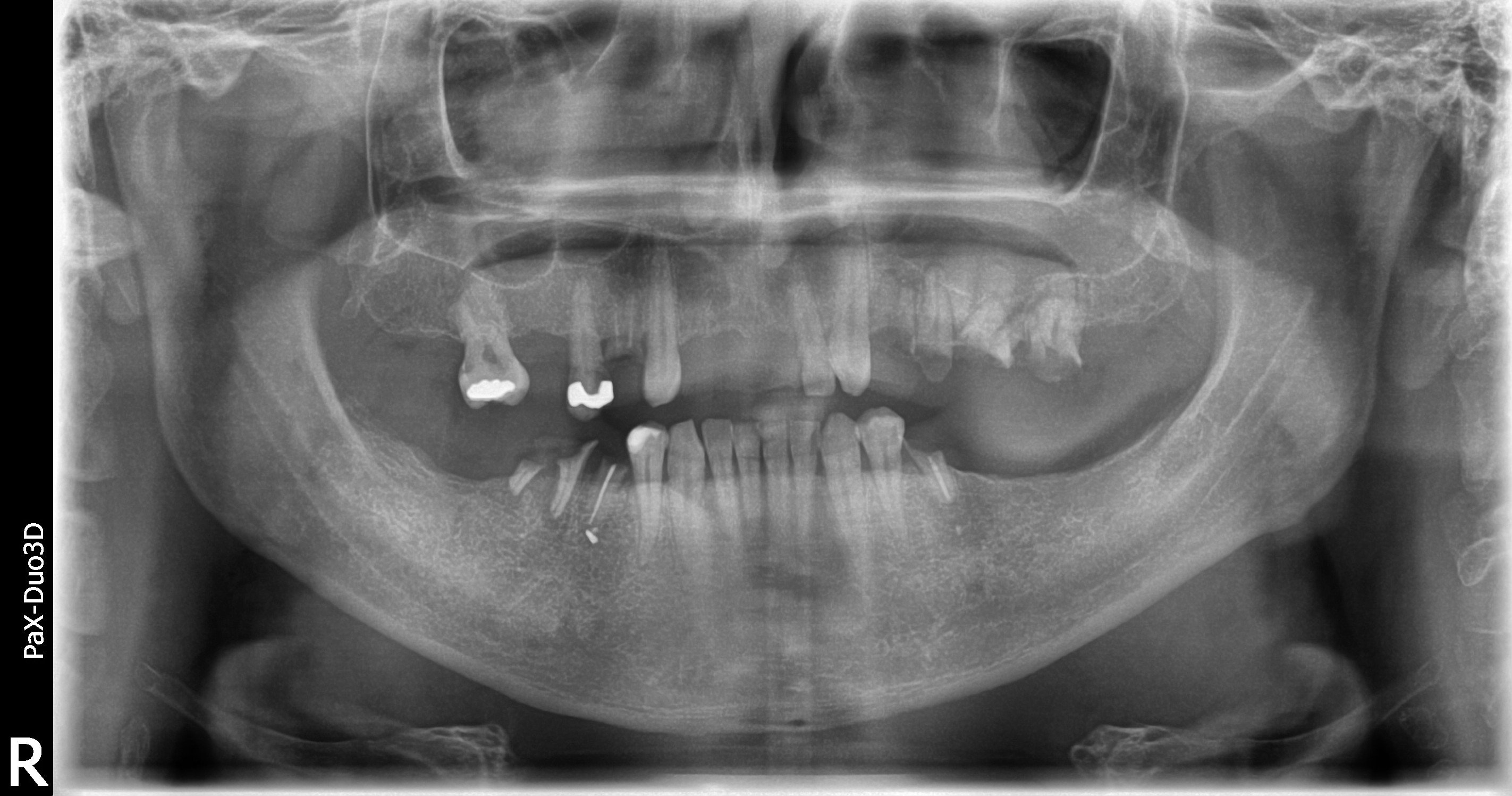 The Process of “Permanent” Fixed Dental Implant Teeth -5 Steps to ...