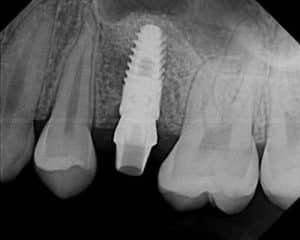 Dizzy/Vertigo After Sinus Lift Bone Graft for Dental Implant