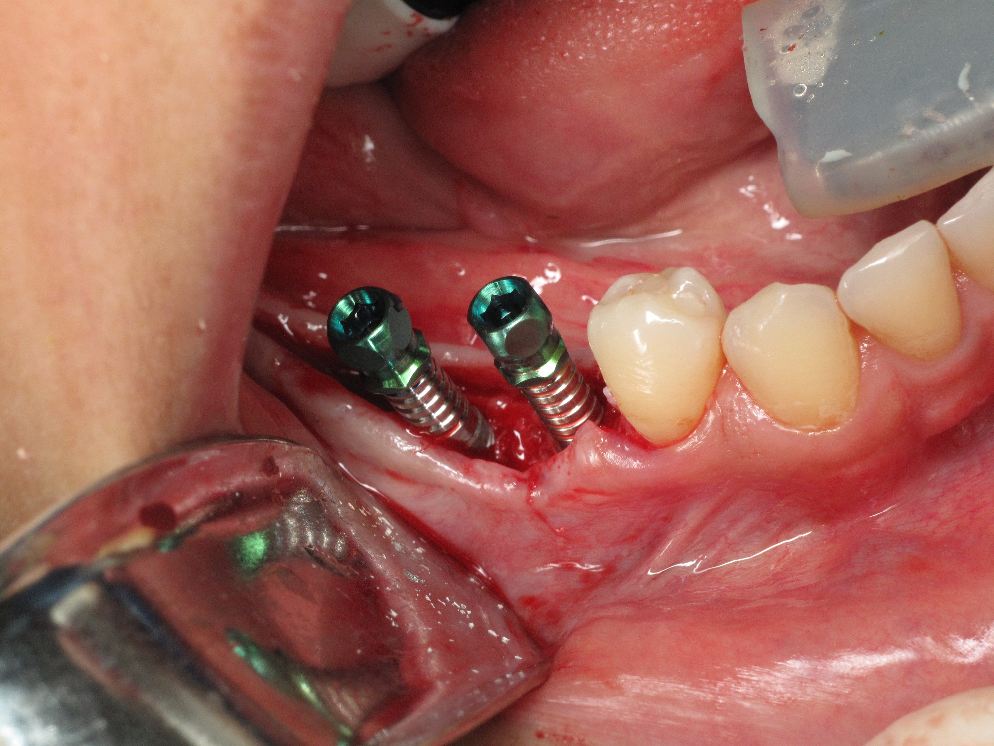 Computer Guided Dental Implant Surgery In Burbank LA Ramsey A Amin Computer Guided Dental Implant Surgery In Burbank LA Ramsey A Amin