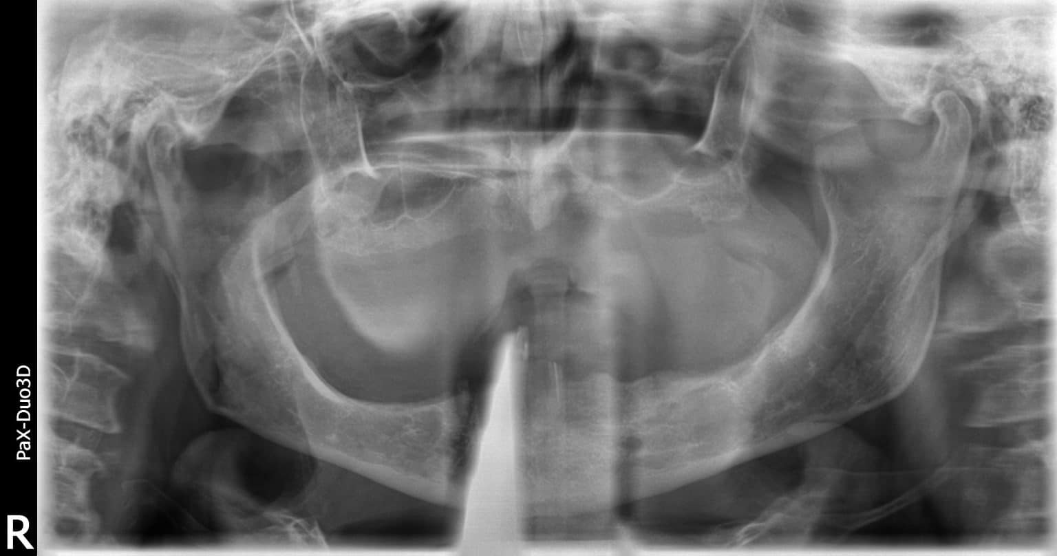 Bone Reduction Leveling For Dental Implants to Avoid a Bone Graft