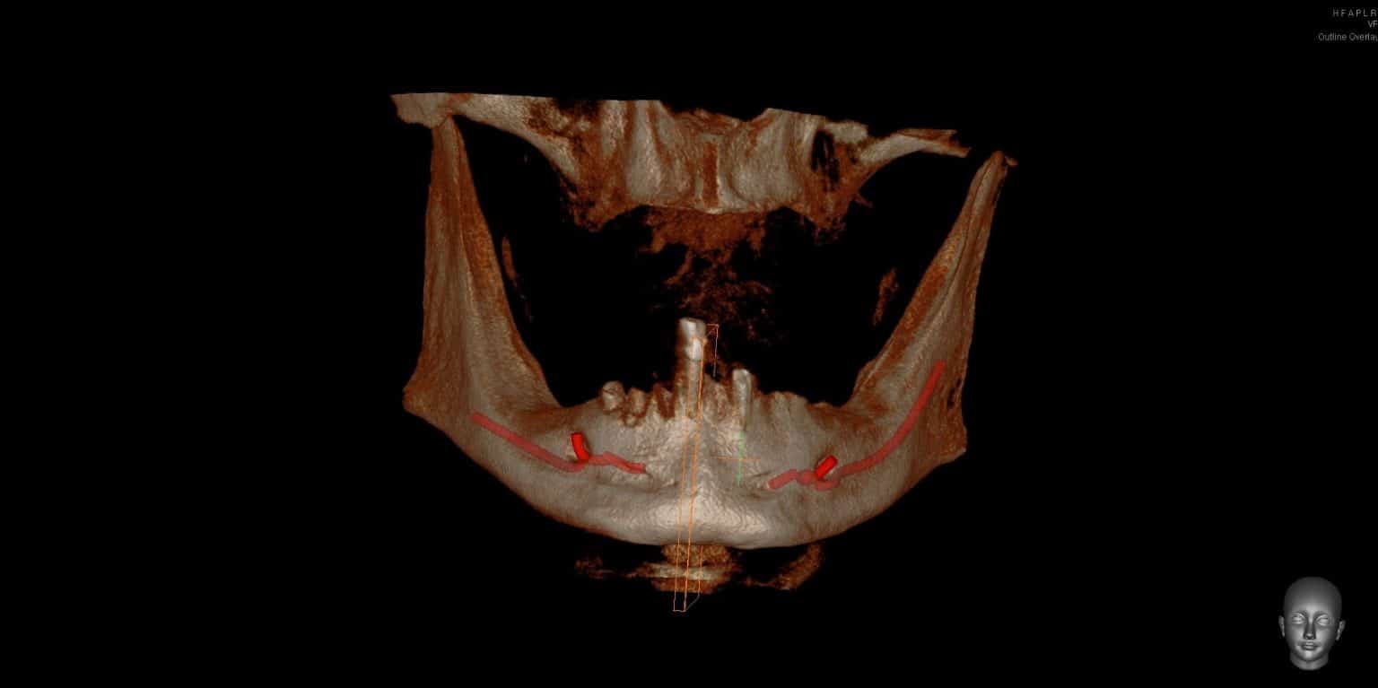Bone Reduction Leveling For Dental Implants to Avoid a Bone Graft