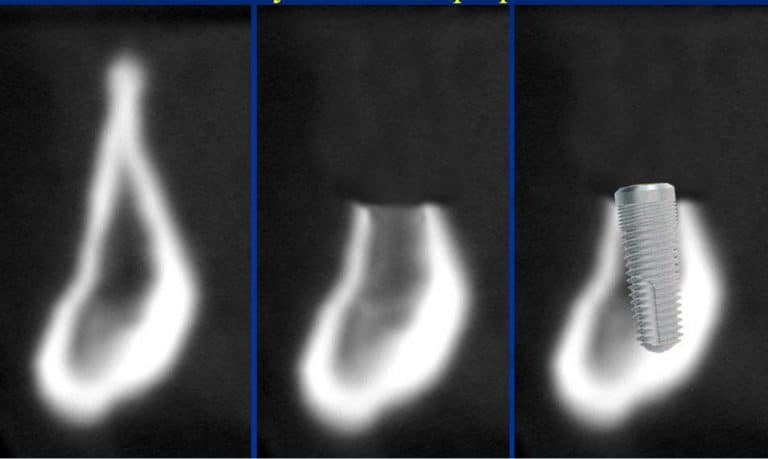 Bone Reduction Leveling For Dental Implants to Avoid a Bone Graft