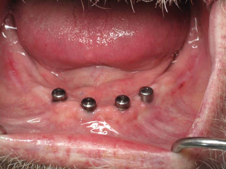 Bone Reduction Leveling For Dental Implants to Avoid a Bone Graft