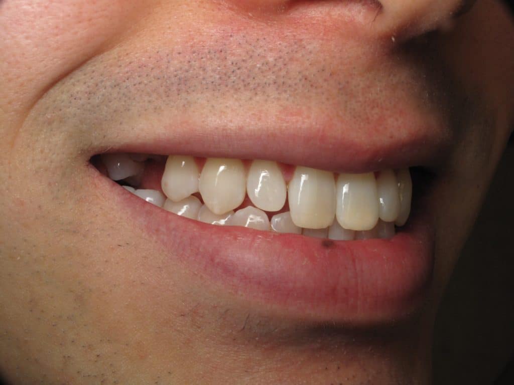 Wisdom Teeth Extraction/Coronectomy With Simultaneous Baby Tooth Dental ...