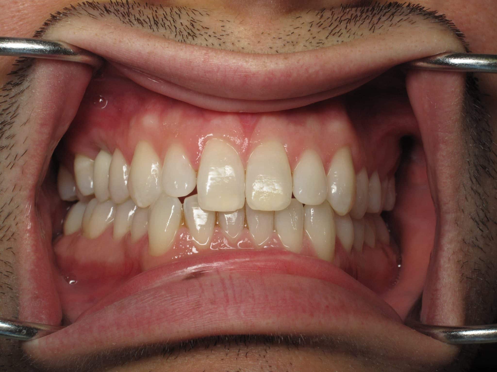 Wisdom Teeth Extraction/Coronectomy With Simultaneous Baby Tooth Dental ...