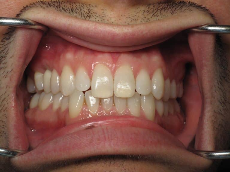 Wisdom Teeth Extraction/Coronectomy With Simultaneous Baby Tooth Dental ...