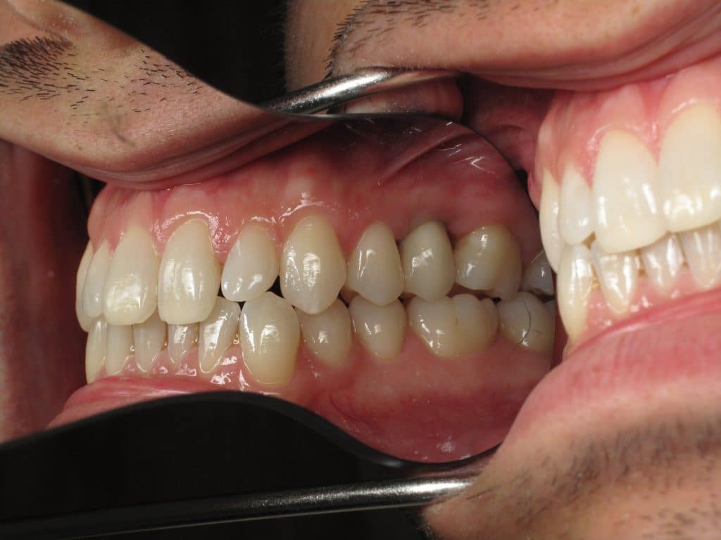 Wisdom Teeth Extraction/Coronectomy With Simultaneous Baby Tooth Dental ...