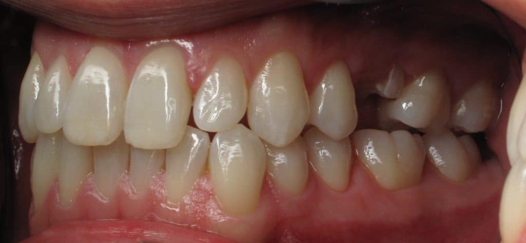 Wisdom Teeth Extraction/Coronectomy With Simultaneous Baby Tooth Dental ...