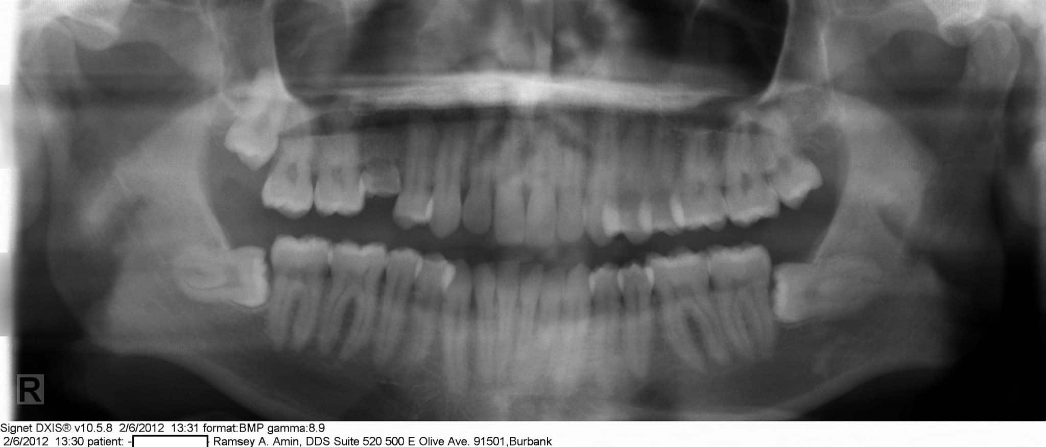 Wisdom Teeth Extraction/Coronectomy With Simultaneous Baby Tooth Dental ...