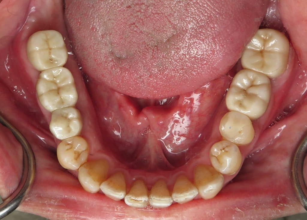 Replacing Four Lower Back Teeth With Dental Implants and Bone Grafting ...