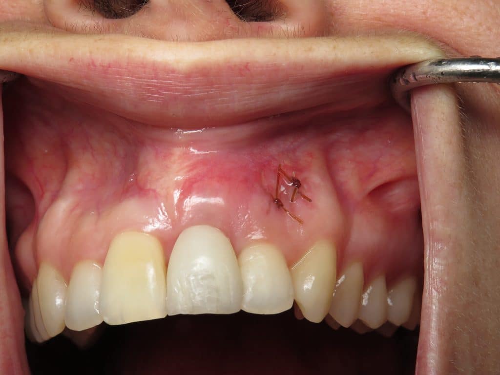 Bone Graft Correcting Dental Implant Peri-Implantitis Bone Loss ~ Case ...