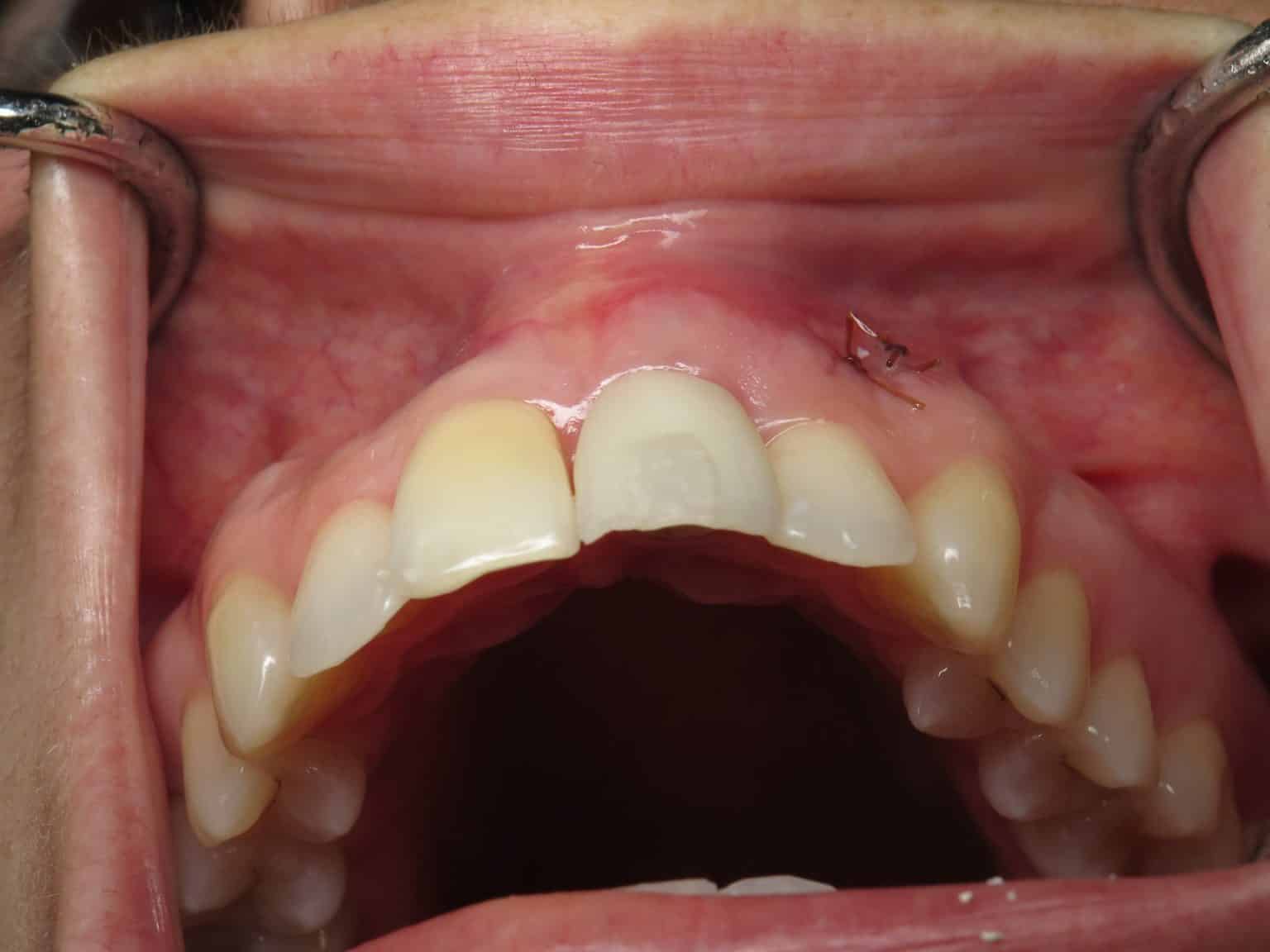 Bone Graft Correcting Dental Implant Peri-Implantitis Bone Loss ~ Case ...