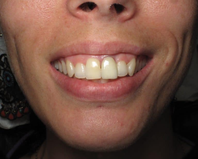 Bone Graft Correcting Dental Implant Peri-Implantitis Bone Loss ~ Case ...