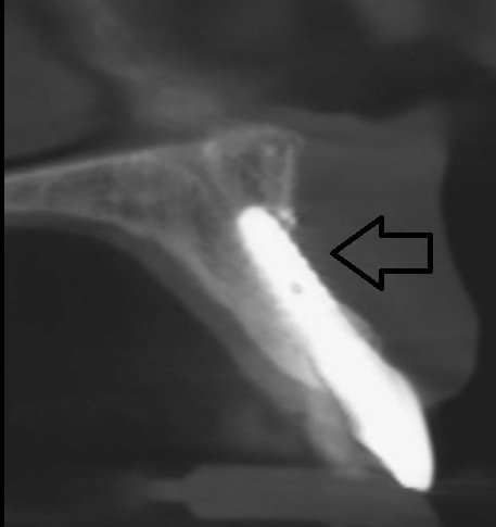 Bone Graft Correcting Dental Implant Peri-Implantitis Bone Loss ~ Case ...