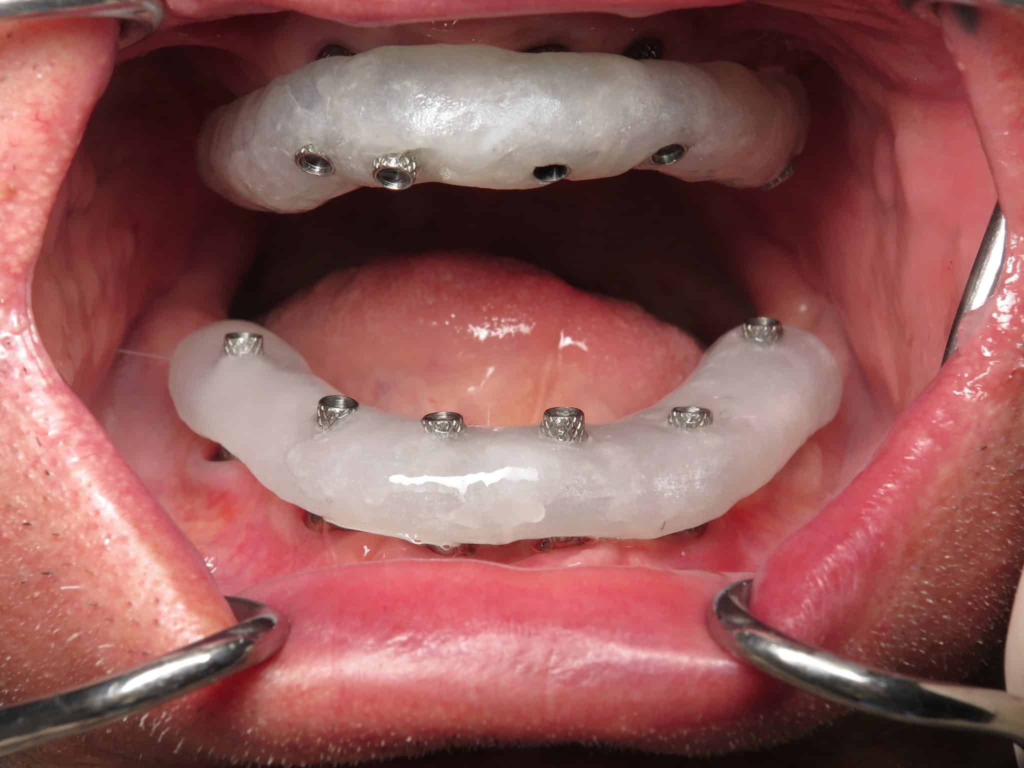 All On Dental Implants With Prettau Solid Zirconia Dental Implant ...