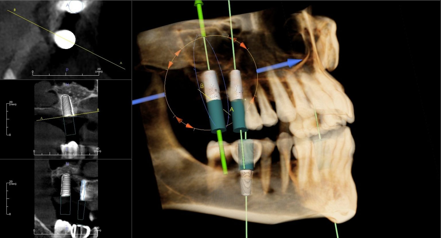 Upper Molars with Sinus Bone Graft and Lower Single Implants -Ramsey ...