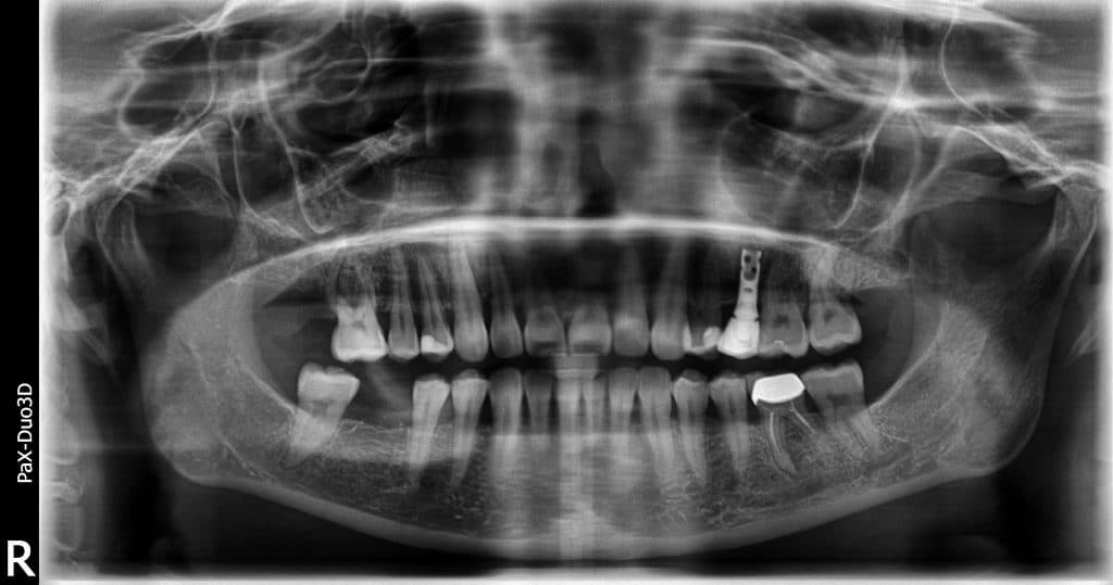 Upper Molars with Sinus Bone Graft and Lower Single Implants -Ramsey ...