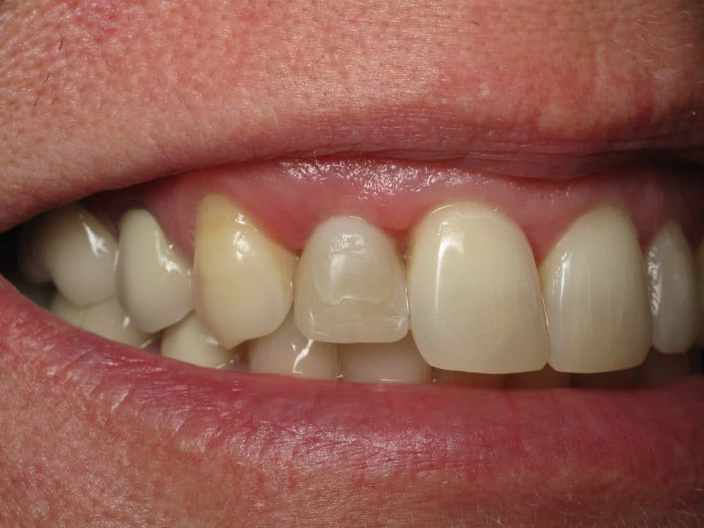 Shaping And Forming Gum Around Front Teeth Dental Implants