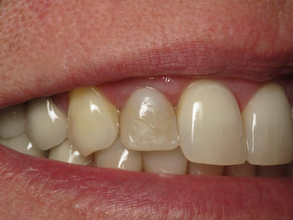 Shaping And Forming Gum Around Front Teeth Dental Implants