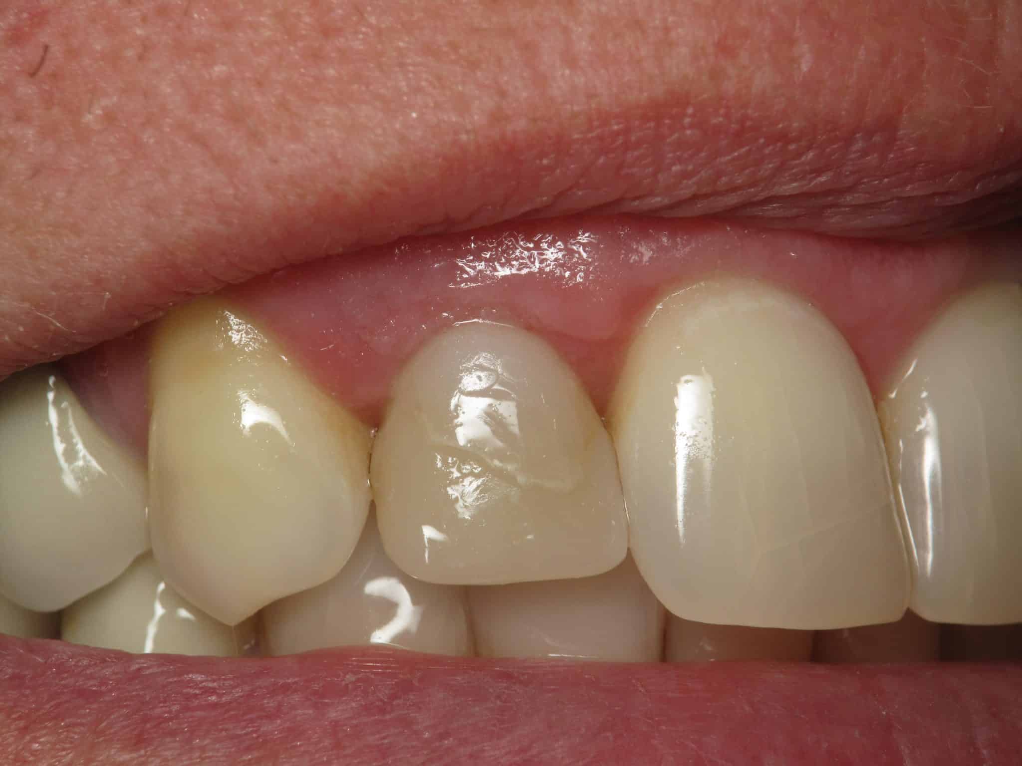 Shaping And Forming Gum Around Front Teeth Dental Implants