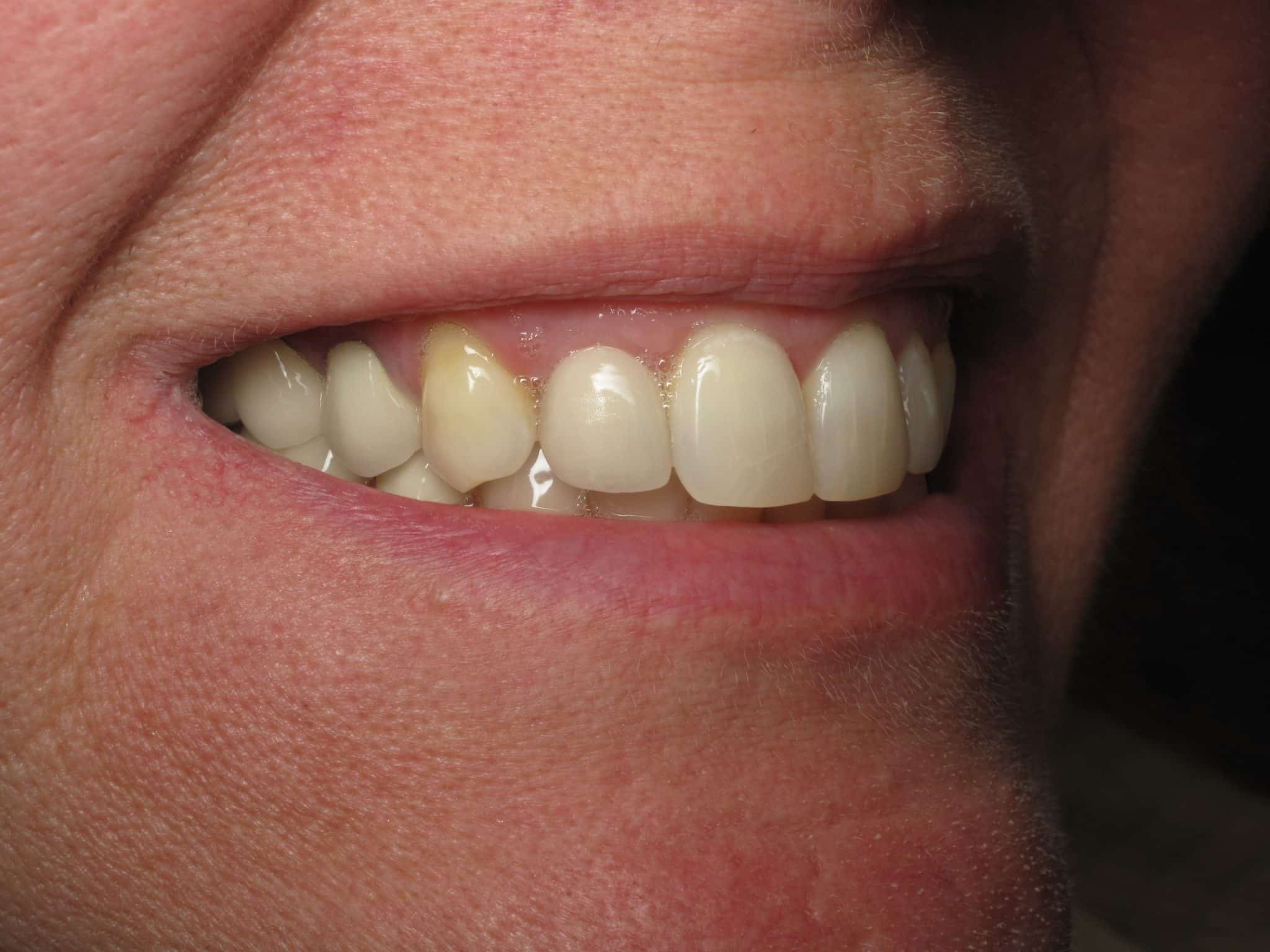 Shaping And Forming Gum Around Front Teeth Dental Implants