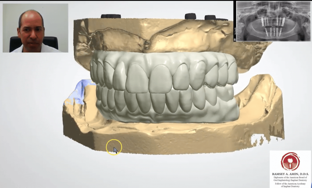 Full Arch All on 4, 5, 6, 7, 8 Implants - 3D Lab Teeth Design Video