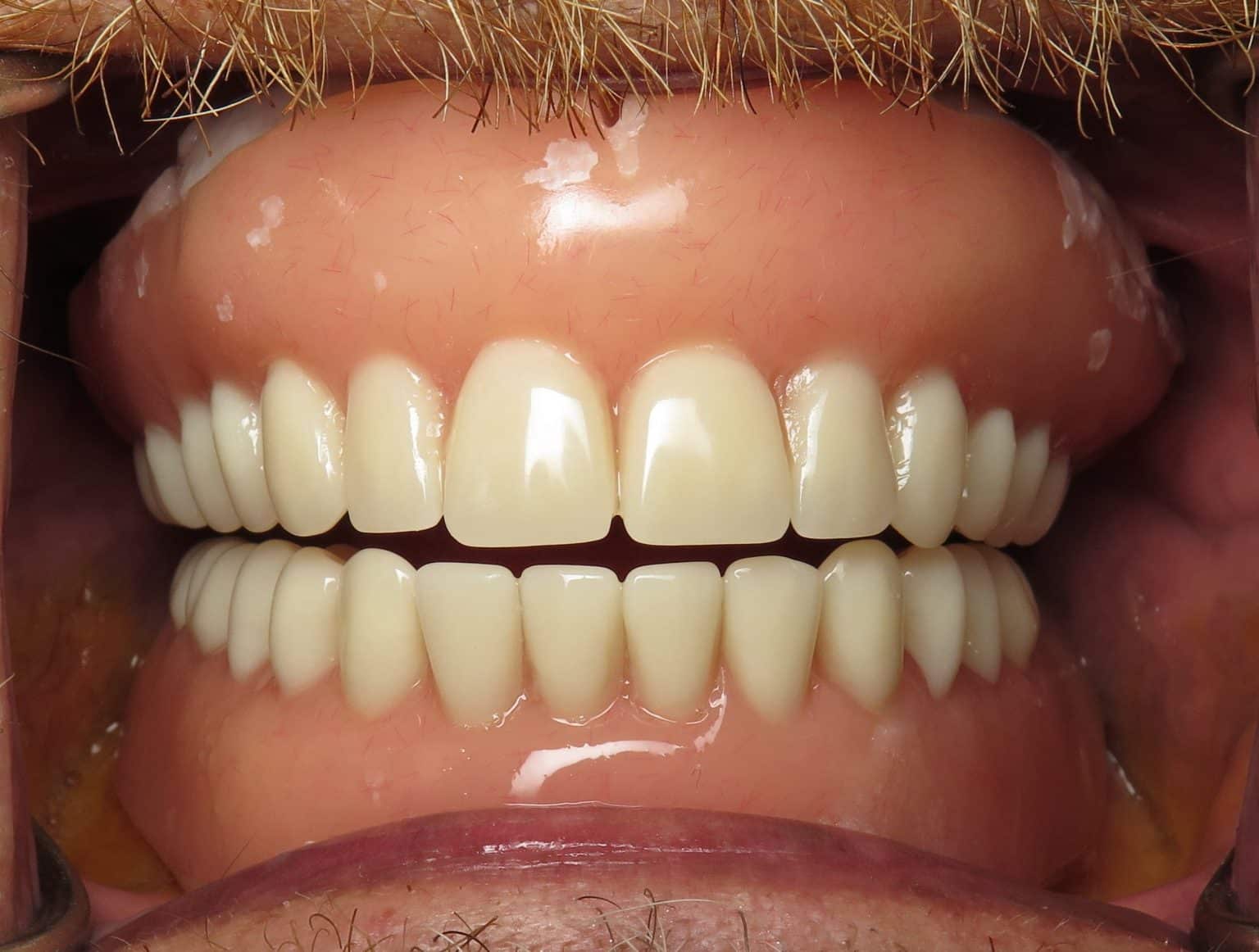 All-On-4 Dental Implant Problems And Complications