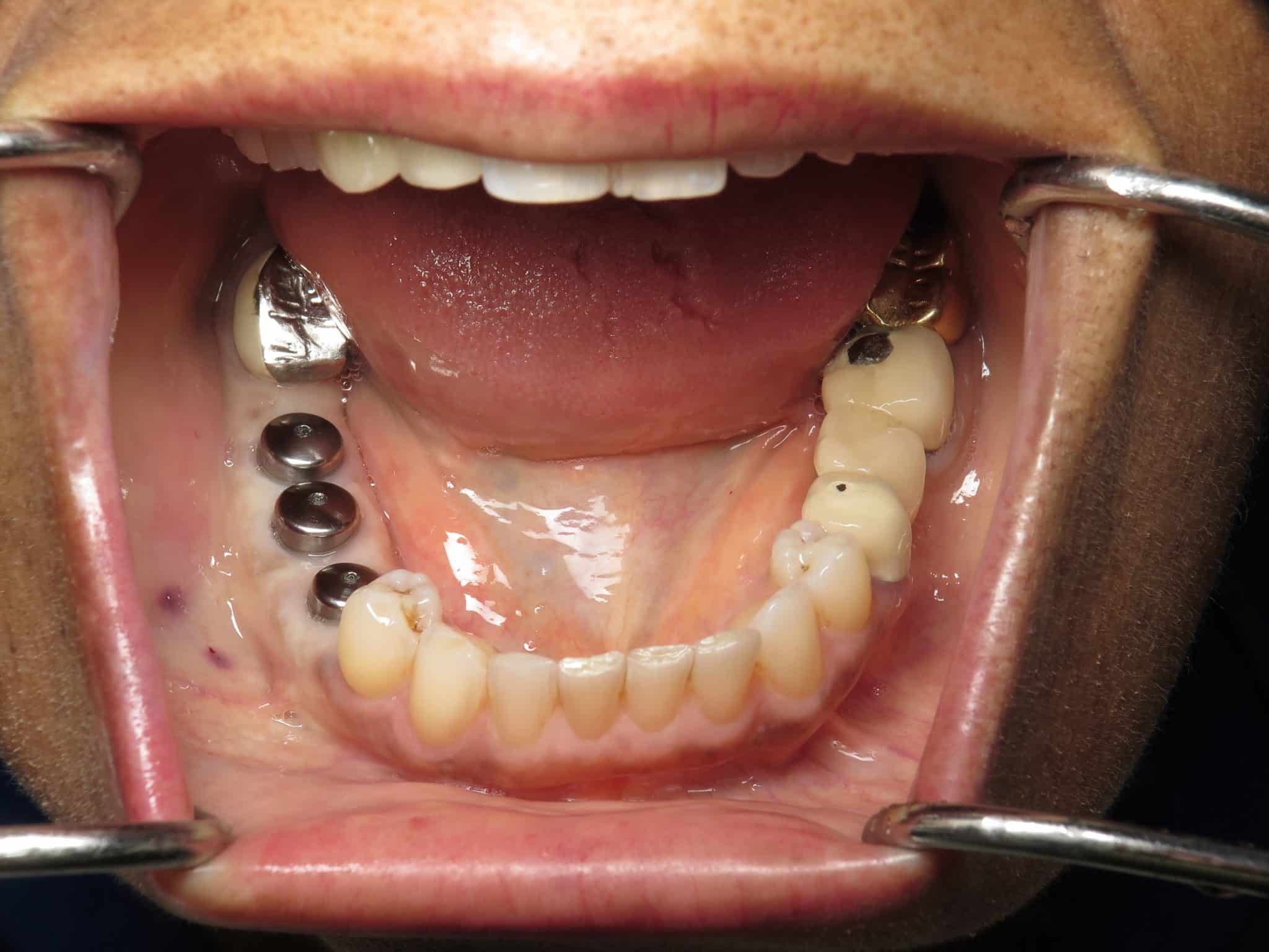 Replace Loose Long Bridge -Dental Implants And Bone Expansion
