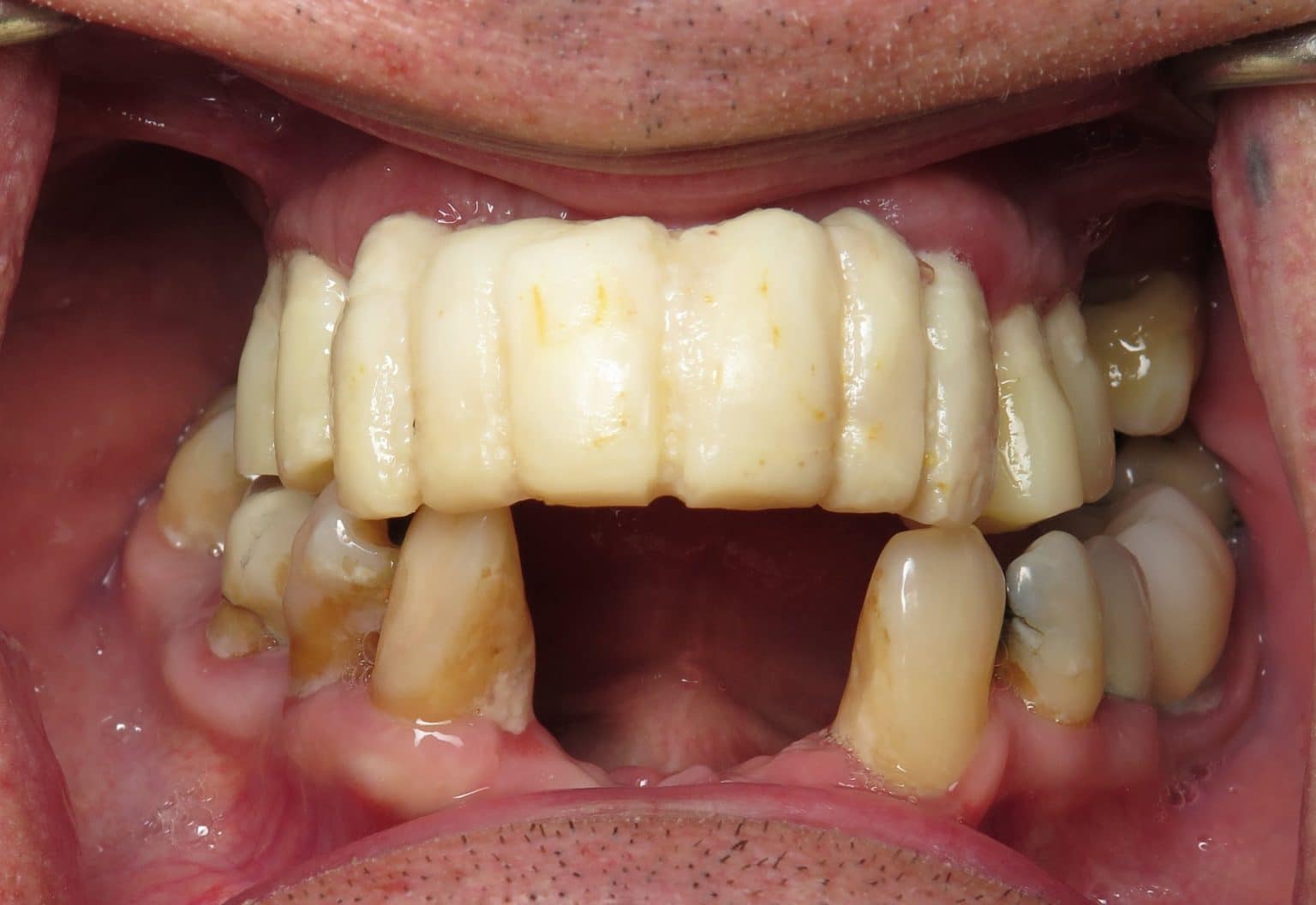 Temporary Full Implant Teeth. Why Do This Step?
