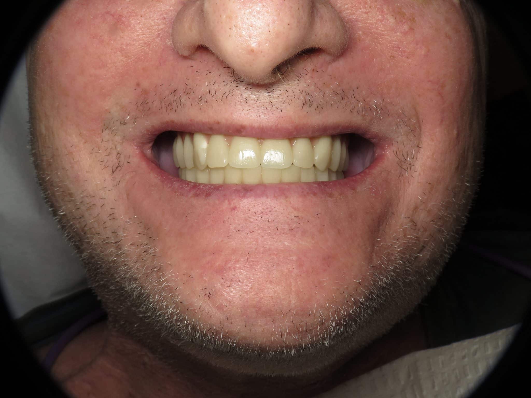 Temporary Full Implant Teeth. Why Do This Step?