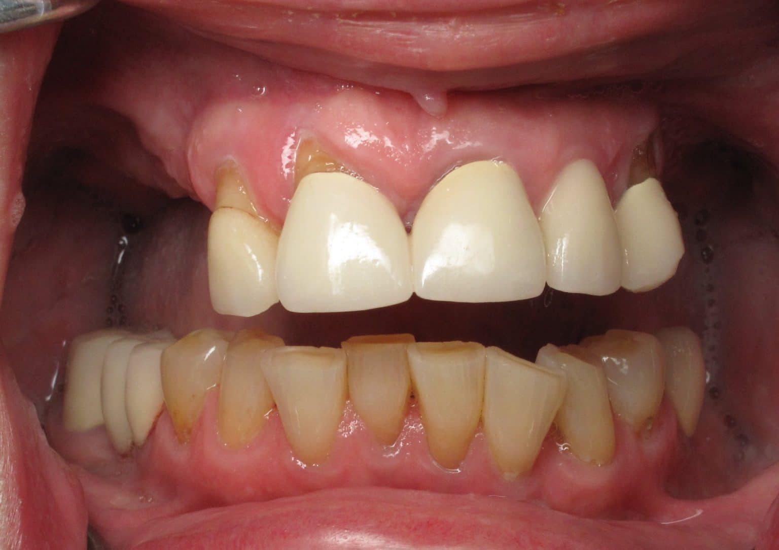 Temporary Full Implant Teeth. Why Do This Step?