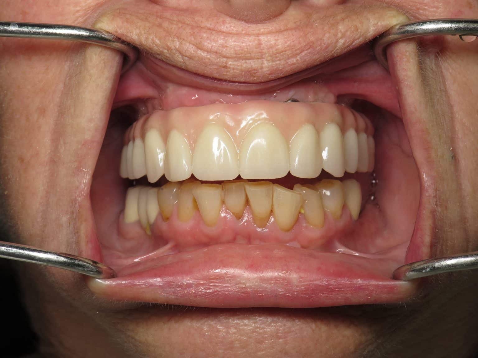 Temporary Full Implant Teeth. Why Do This Step? | Ramsey Amin, DDS