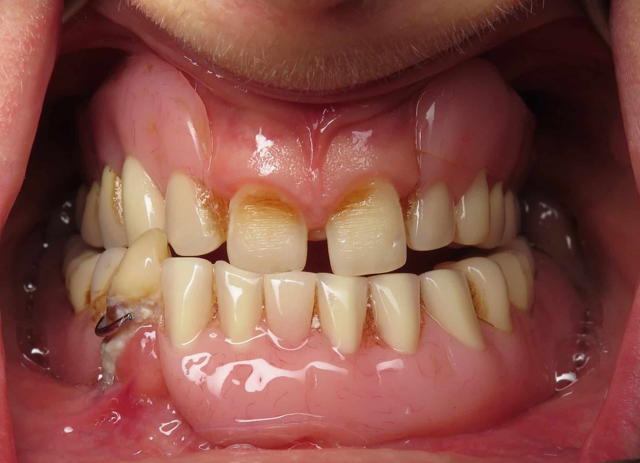 Temporary Full Implant Teeth. Why Do This Step? | Ramsey Amin, DDS
