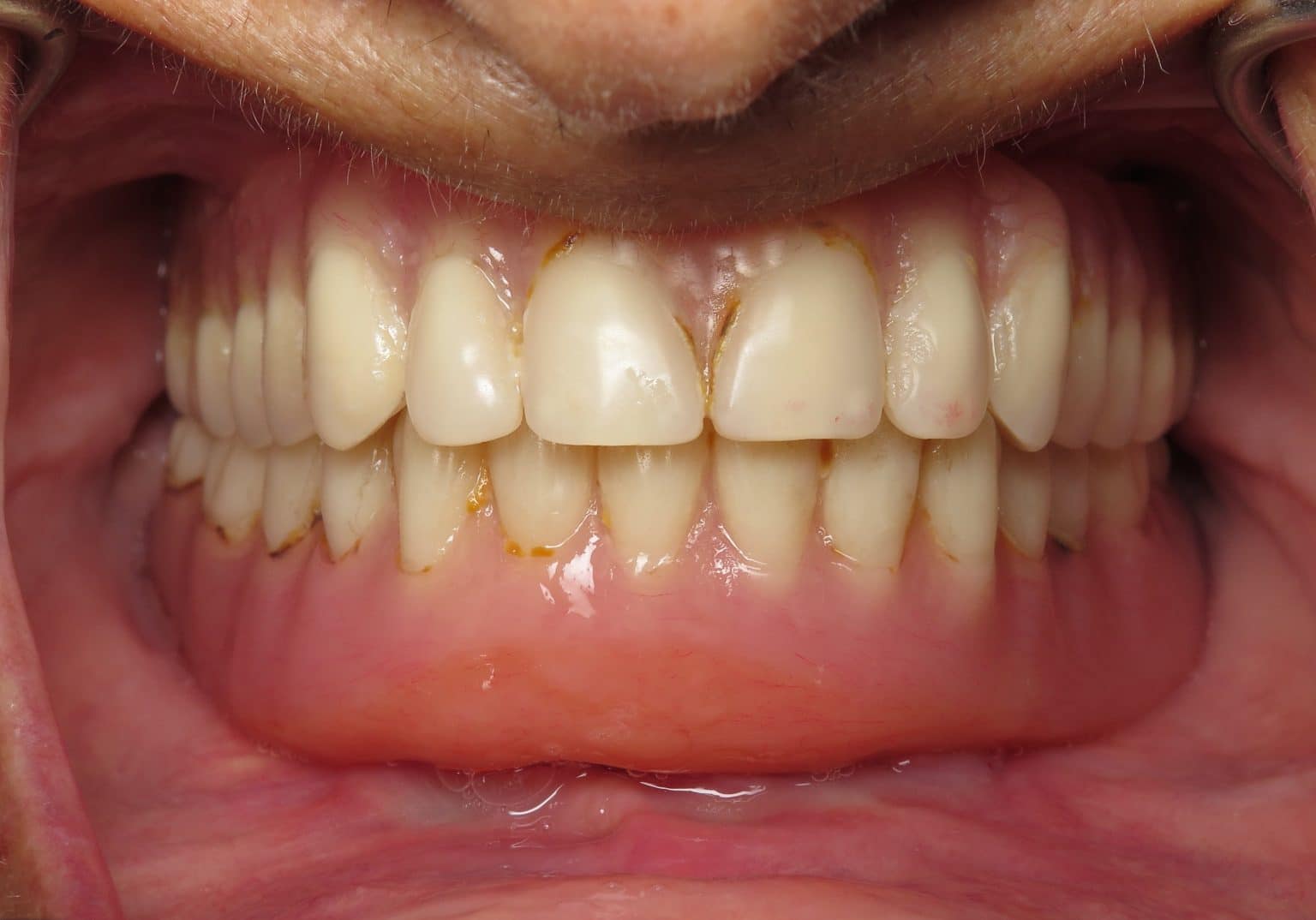 Complications-Bone Graft For Failed Full Lower Dental Implants