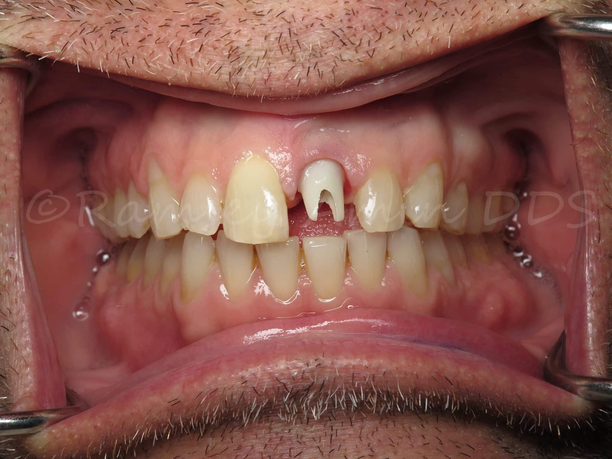 Center Front Dental Implant -Ramsey Amin DDS Center Front Dental Implant -Ramsey Amin DDS