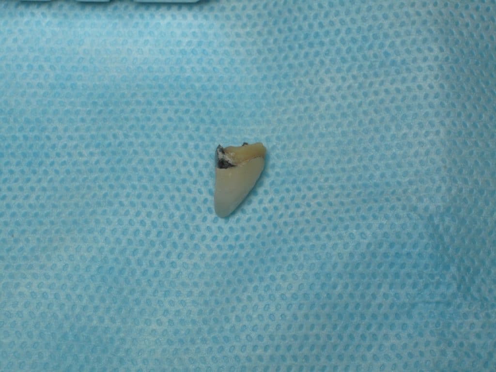 Lower Front Tooth Implants 4662
