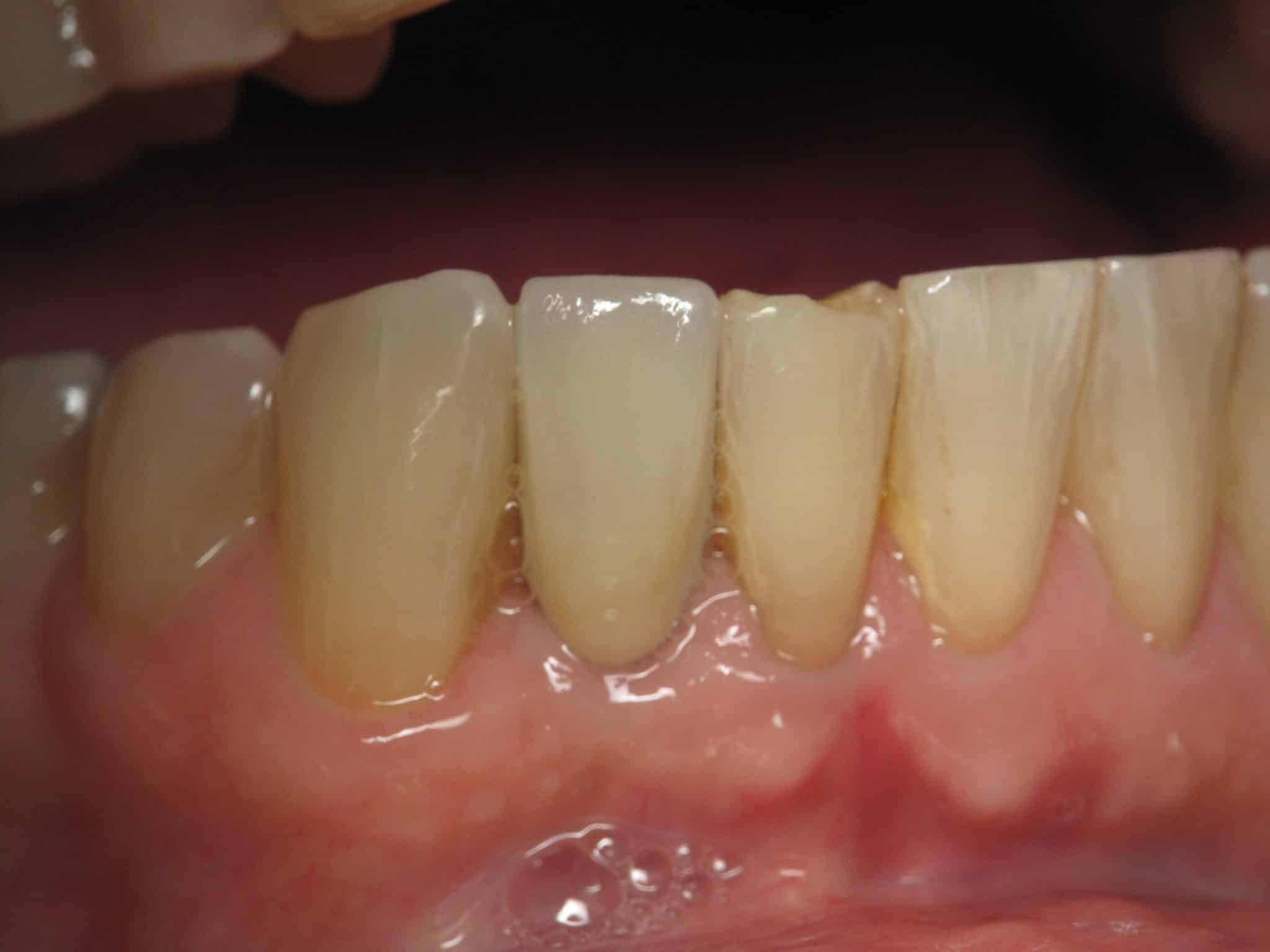Lower Front Tooth Implants