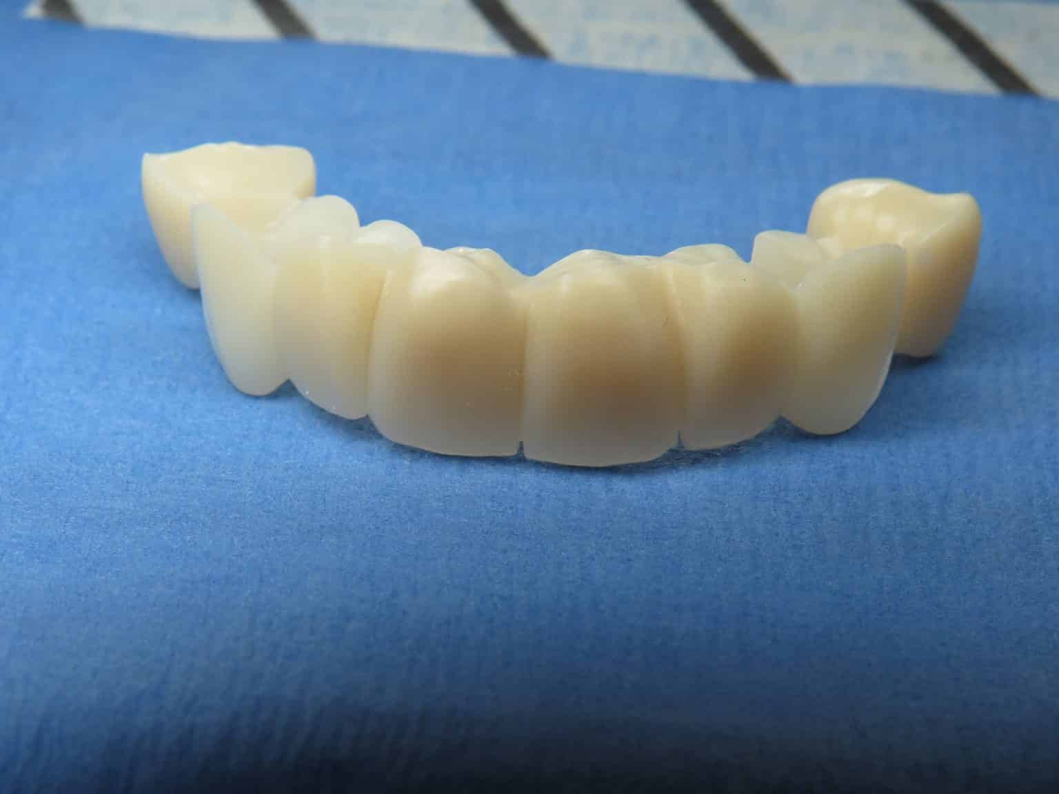 Flipper/Stayplate/Bridge Temporary Implant Bone Graft Facts