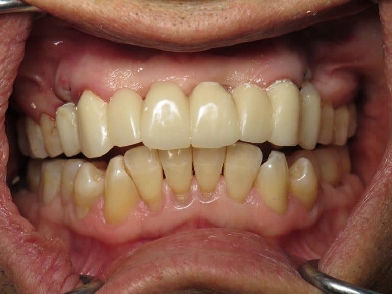 Flipper/Stayplate/Bridge Temporary Implant Bone Graft Facts